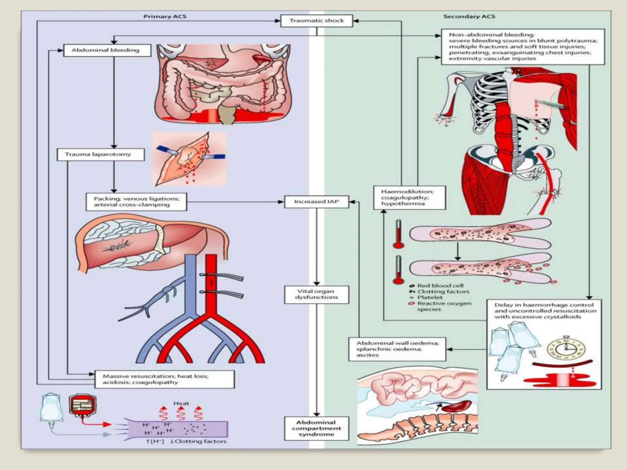Compartment syndrome, meaning , types, causes , nursing management ...