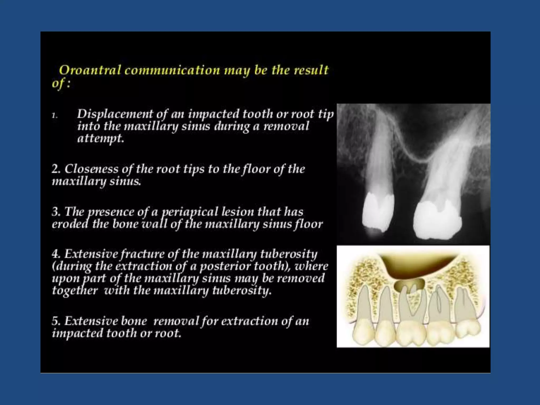 Complication of tooth extraction | PPTX