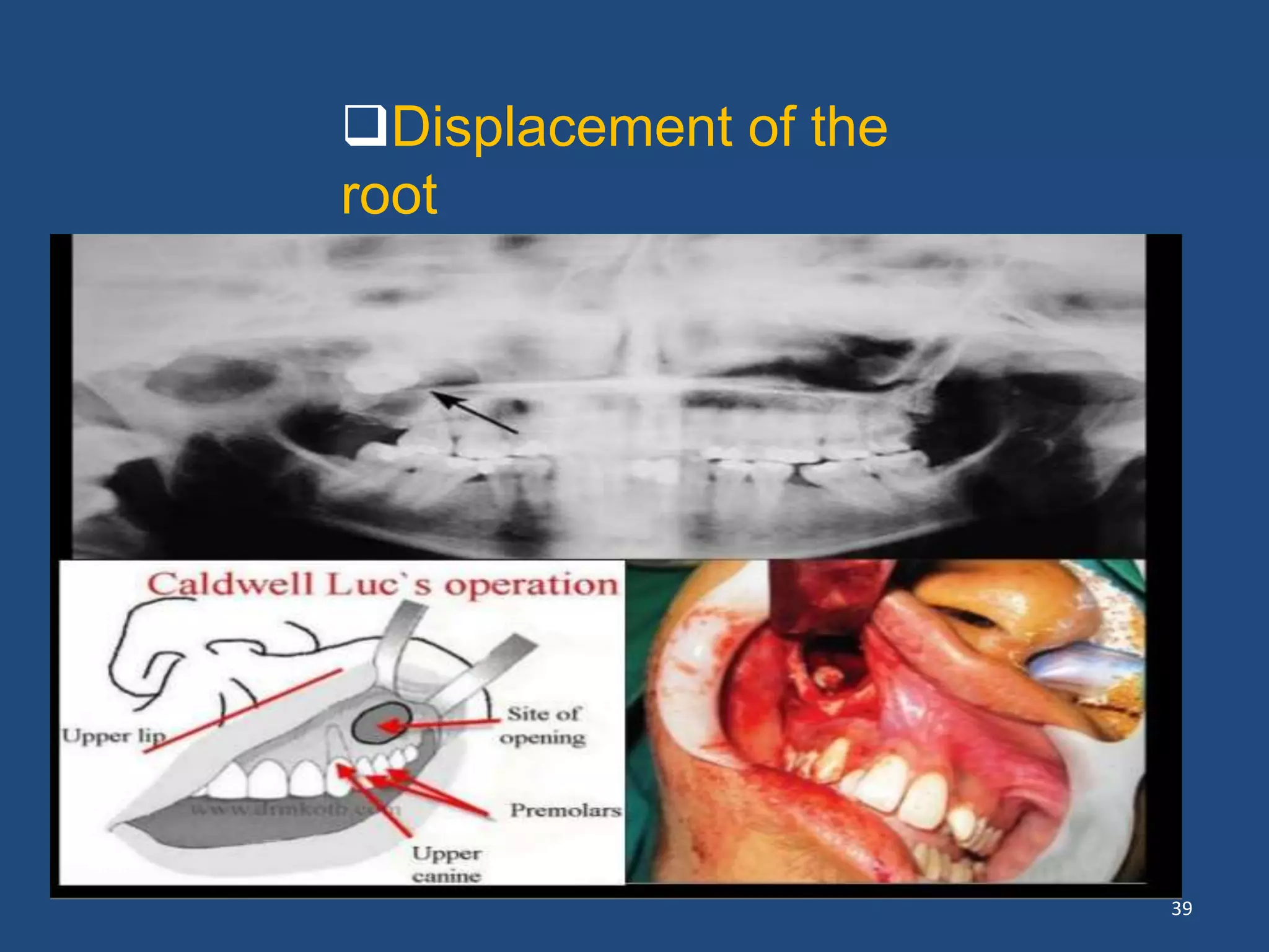 Complication of tooth extraction | PPTX