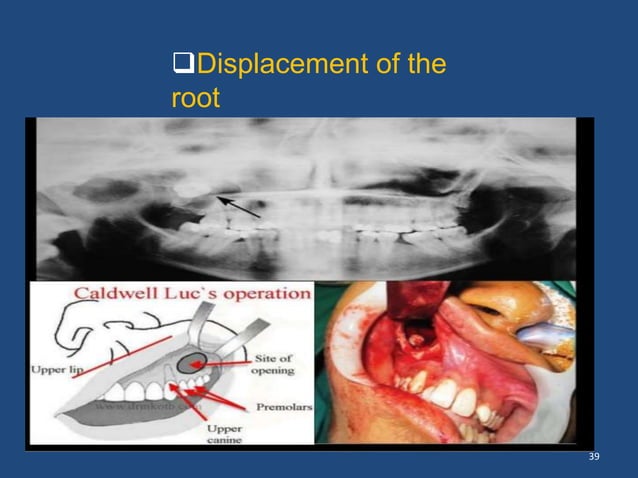 Complication of tooth extraction | PPTX | Dental Health | Diseases and ...