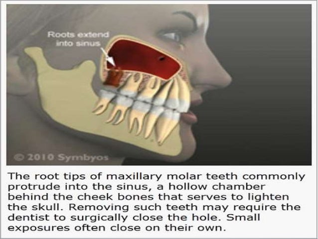Complication and management of tooth extraction or exodontia