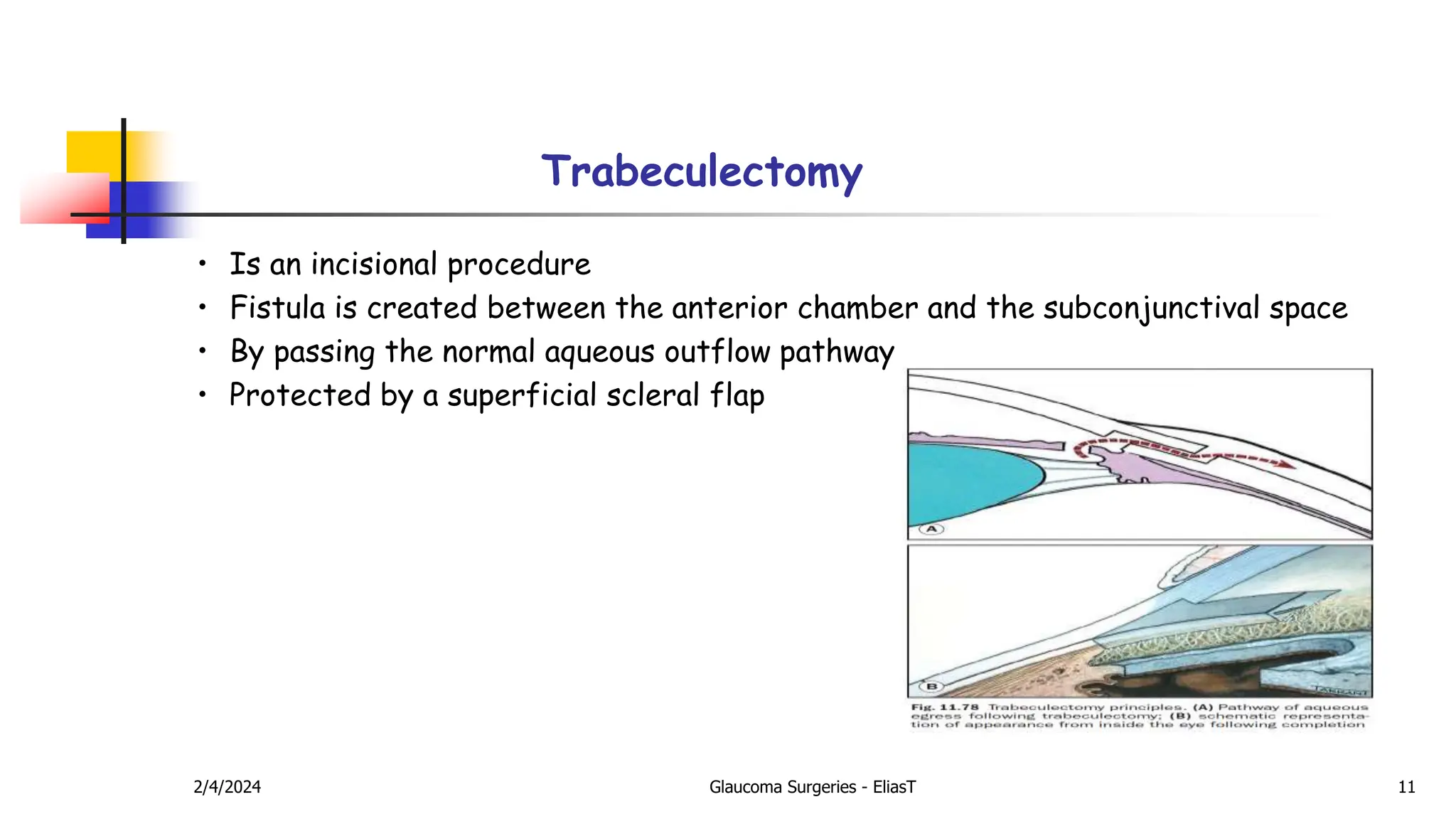 Surgical Management of Glaucoma-Elias.pptx