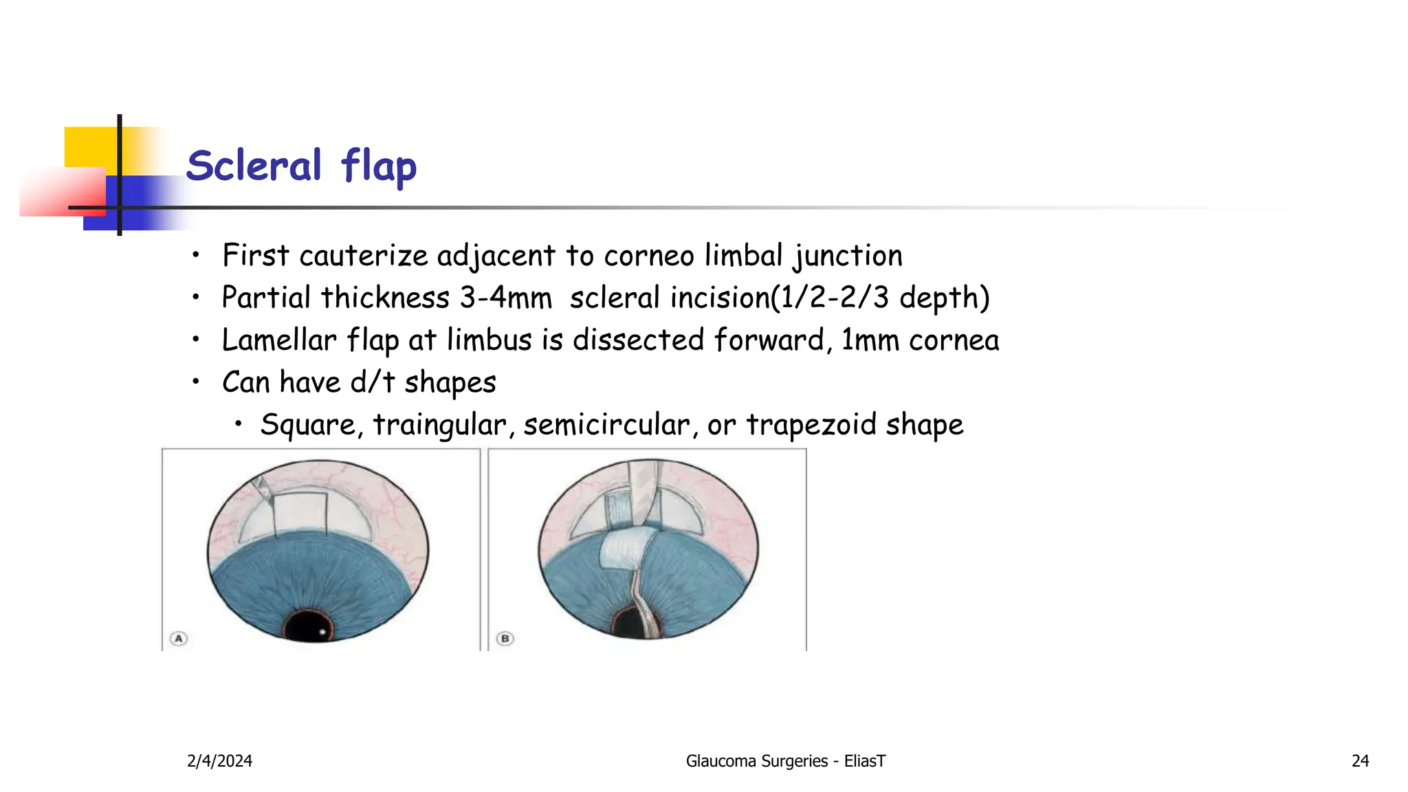 Surgical Management of Glaucoma-Elias.pptx