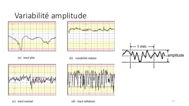 Comment utiliser le cardiotocographe, Jan Nkeck