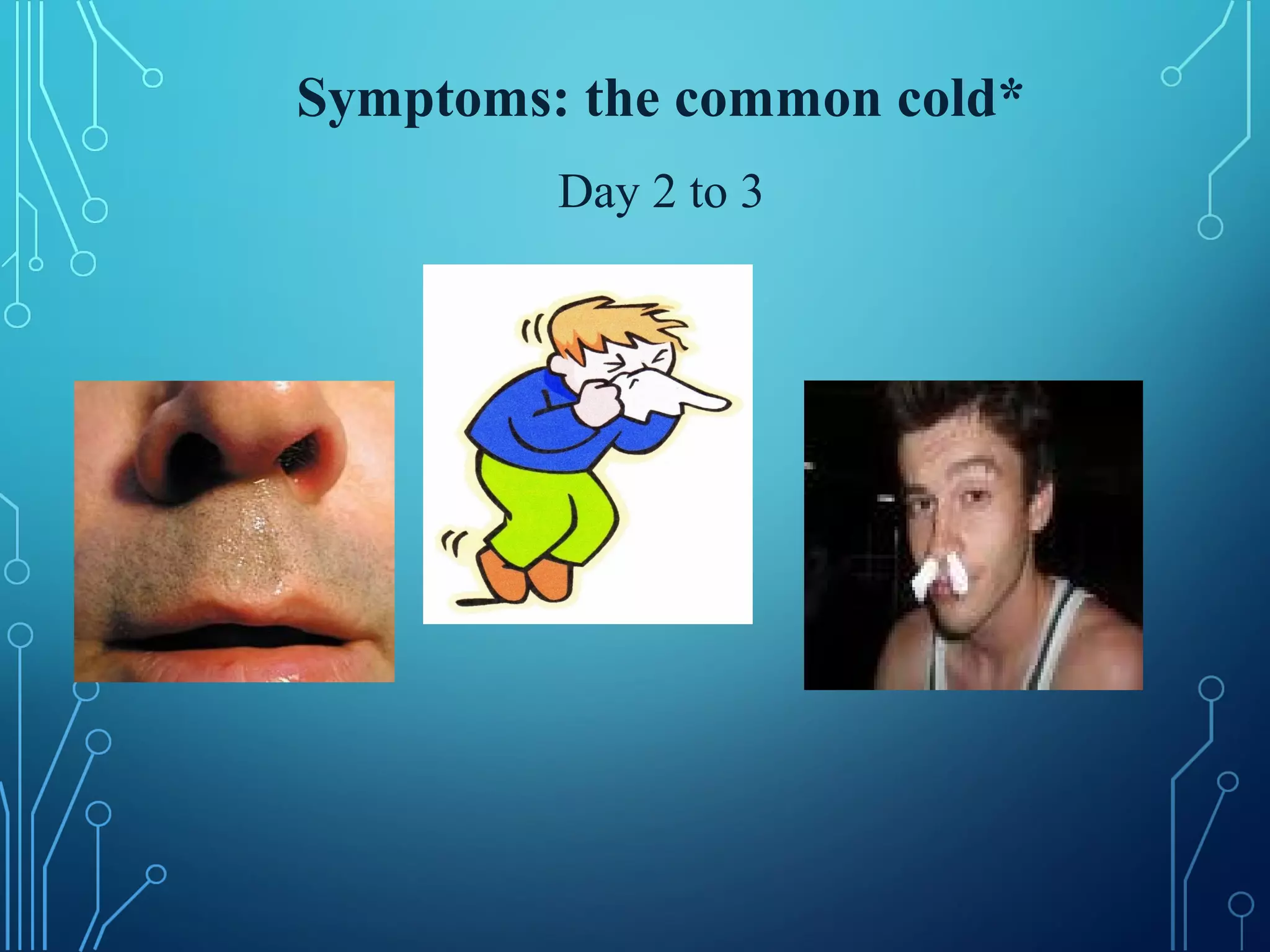 Common cold | PPT