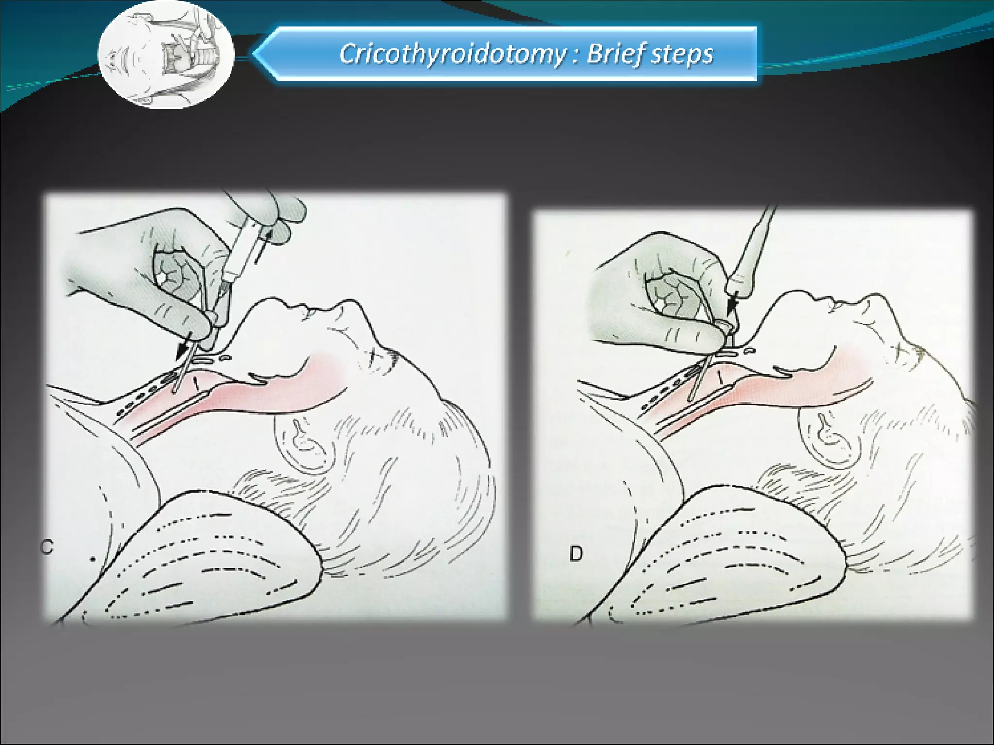 Common pitfalls in ER Procedure | PPT