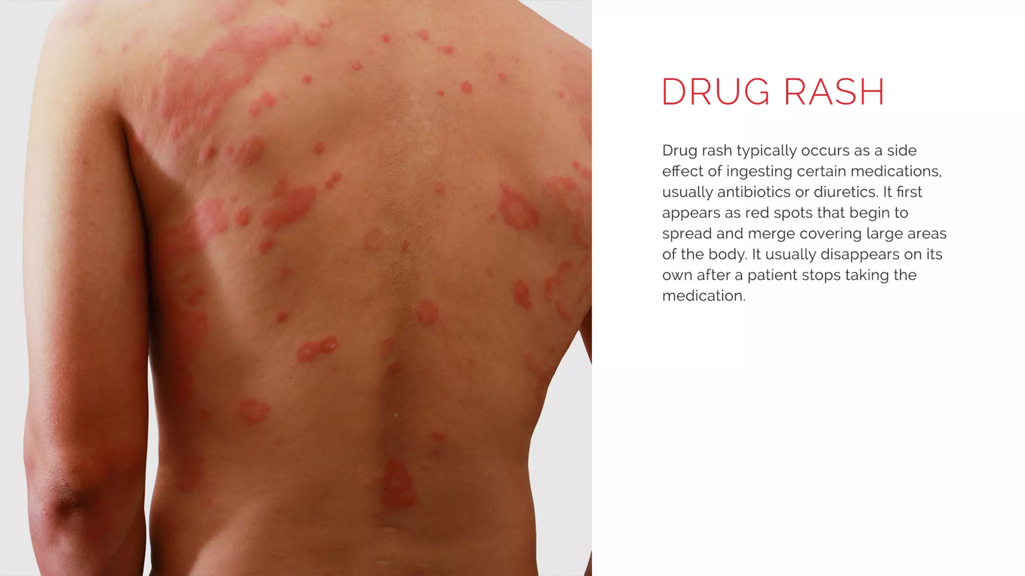 Types of Common Skin Rashes | PDF