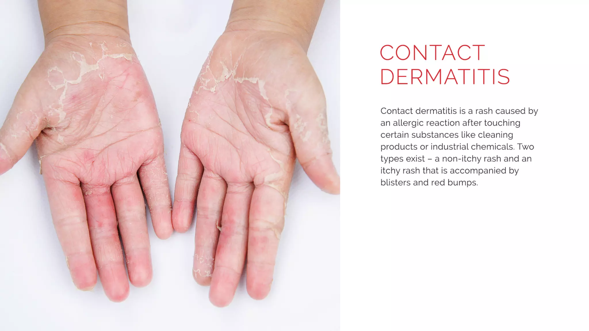 Types of Common Skin Rashes | PDF | Skin and Dermatology | Diseases and ...
