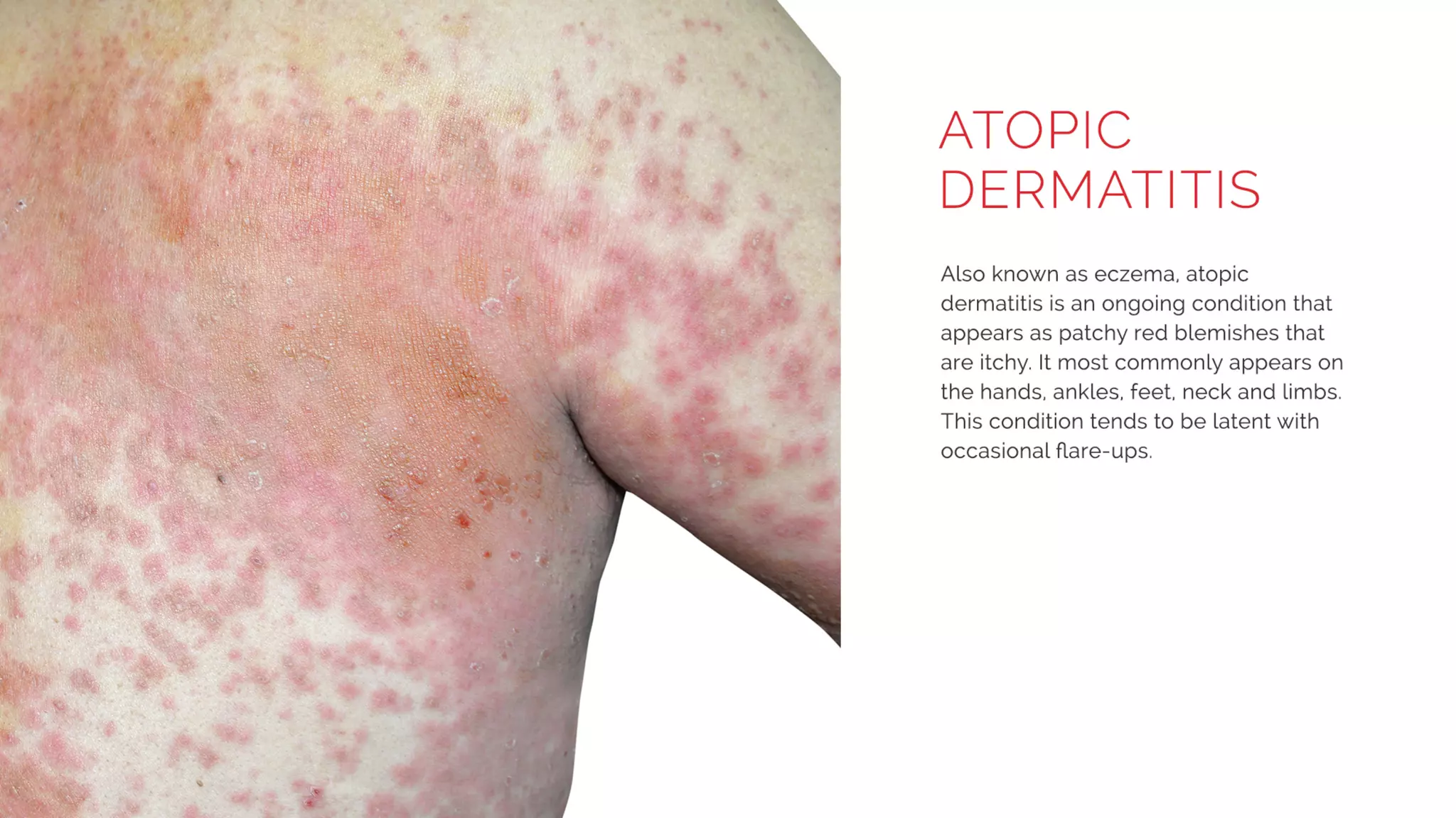 Types of Common Skin Rashes | PDF | Skin and Dermatology | Diseases and ...