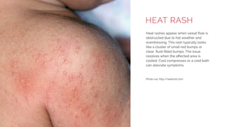 Types of Common Skin Rashes | PDF