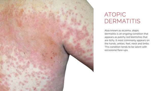 Types of Common Skin Rashes