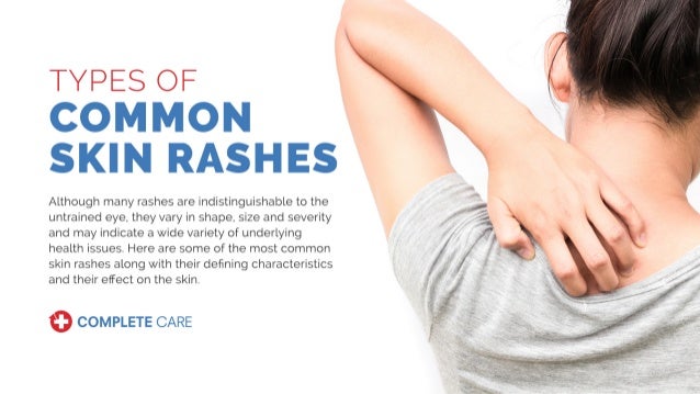 Types of Common Skin Rashes