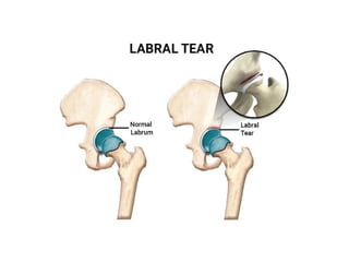COMMON ACUTE AND OVERUSE INJURIES OF HIP JOINT.pptx