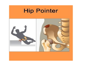 COMMON ACUTE AND OVERUSE INJURIES OF HIP JOINT.pptx