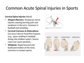 Common acute and overuse injuries of spine.pptx