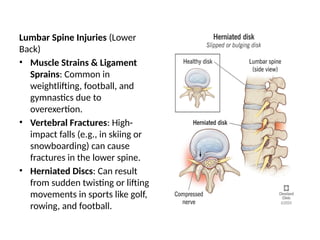 Common acute and overuse injuries of spine.pptx