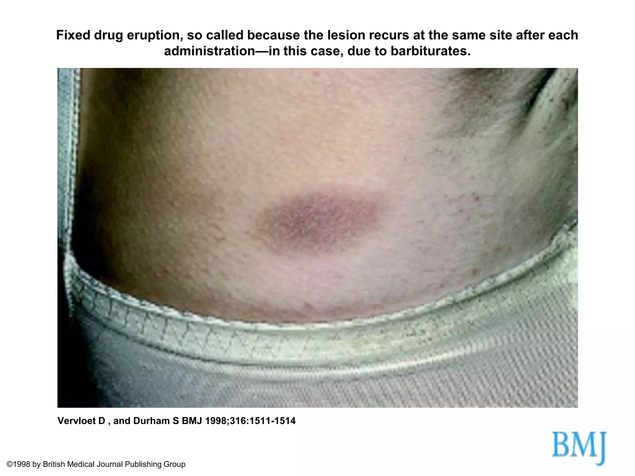Common Adverse Drug Reactions | PPTX