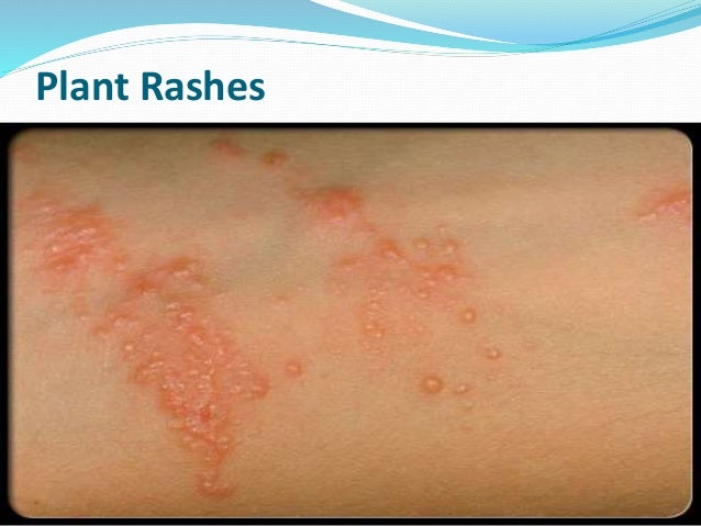 Algorithm Common Skin Conditions