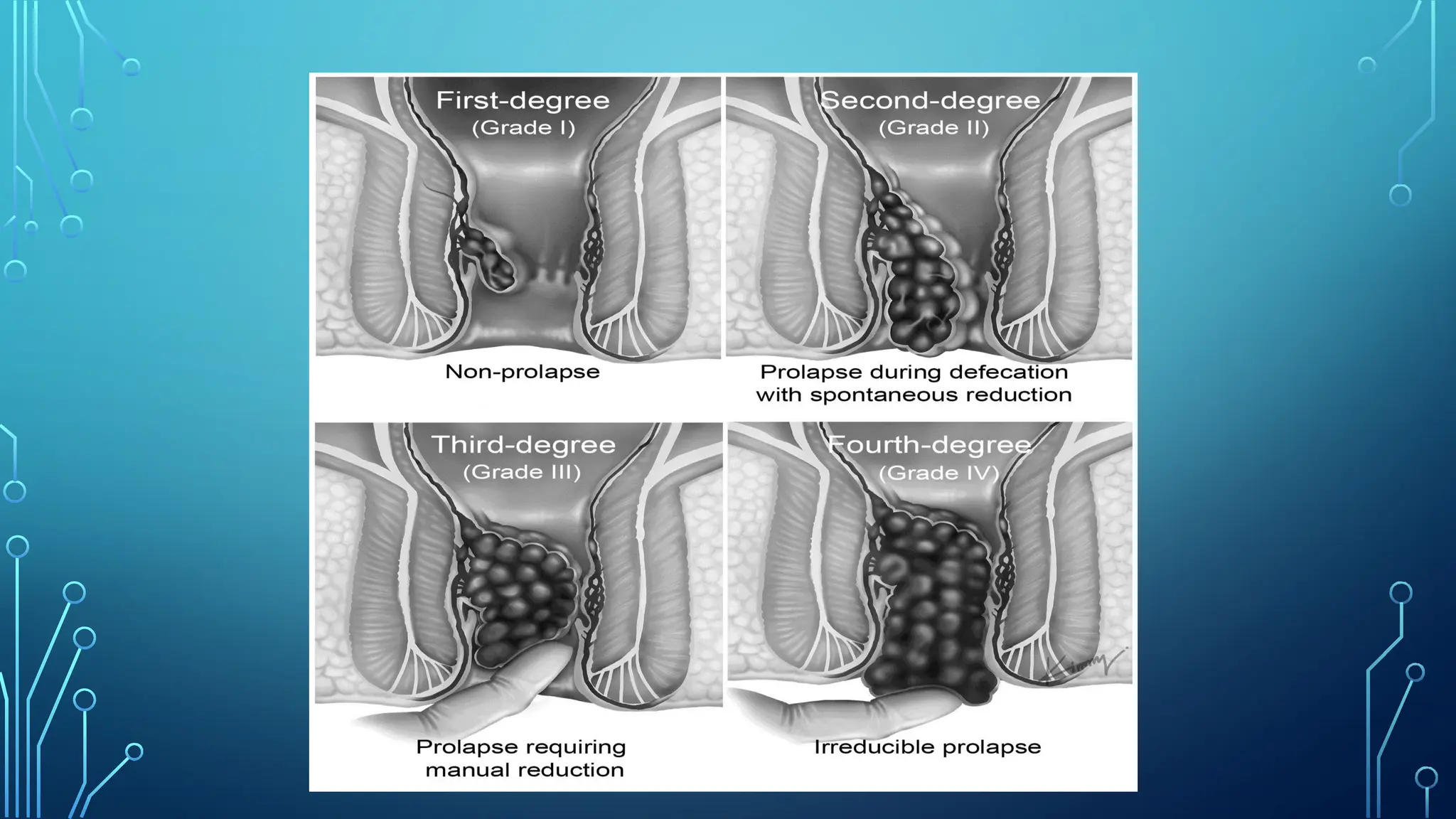 common anorectal diseases (hemorrhoids, anal fissure, rectal prolapse ...