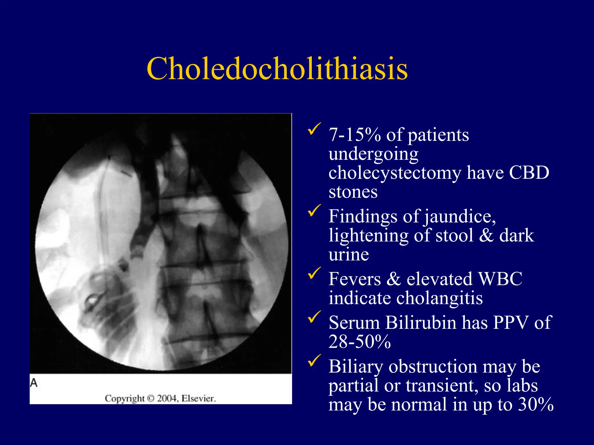 Common BD stones etiology and management the lect.ppt