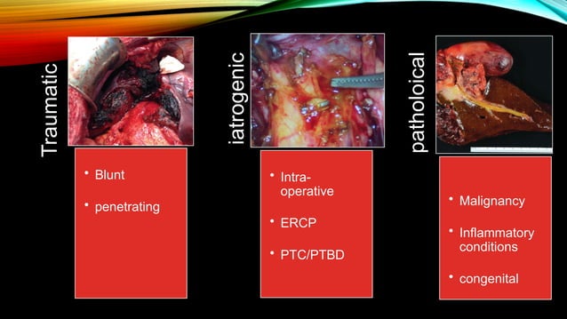 Common Bile duct injuries and their management (Recent guidelines 2022 ...