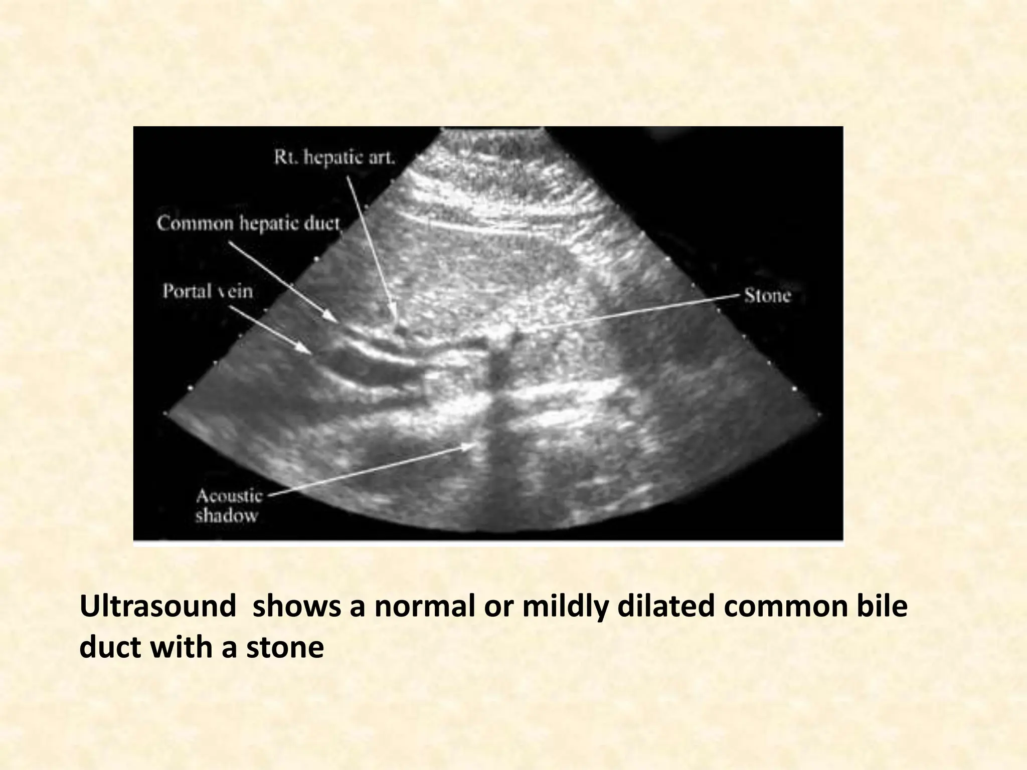 common_bile_duct_stones_stricture. POWER | PPT