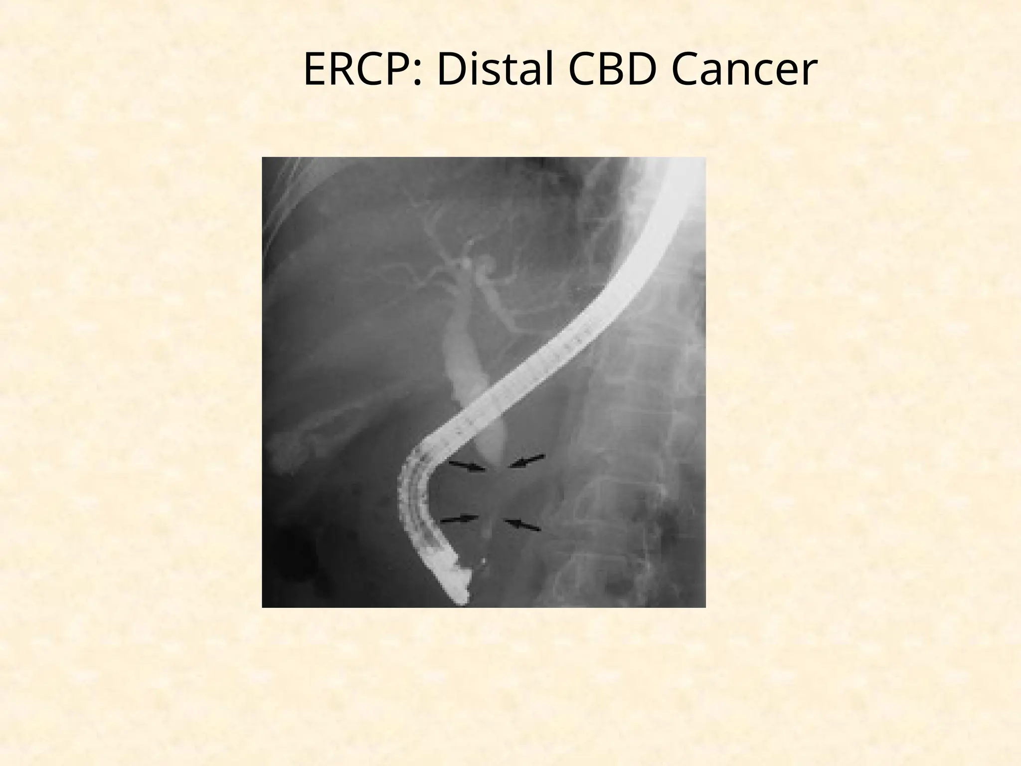 common_bile_duct_stones_stricture.ppttttttt | PPT