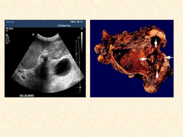 common_bile_duct_stones_stricture.ppttttttt | PPT