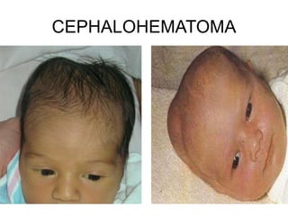Cephalohematoma