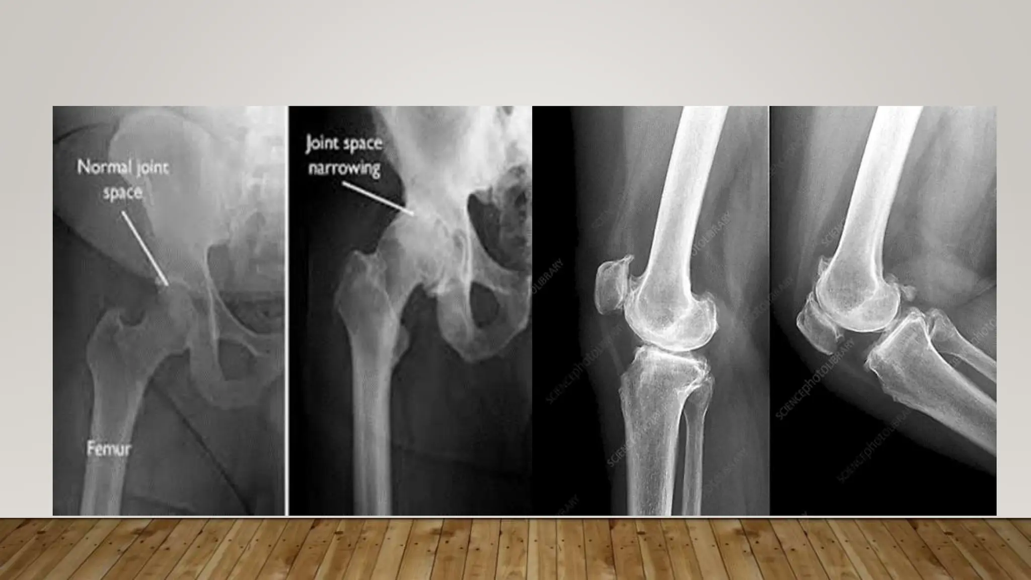 Common Bone Pathologies esp arthrit.pptx | Bone and Joint Conditions ...