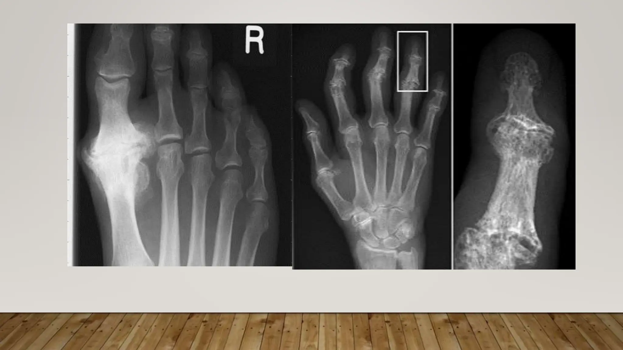 Common Bone Pathologies esp arthrit.pptx | Bone and Joint Conditions ...