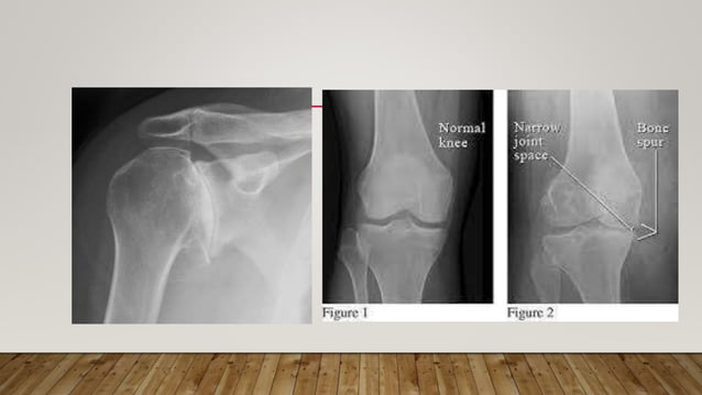 Common Bone Pathologies esp arthrit.pptx | Bone and Joint Conditions ...