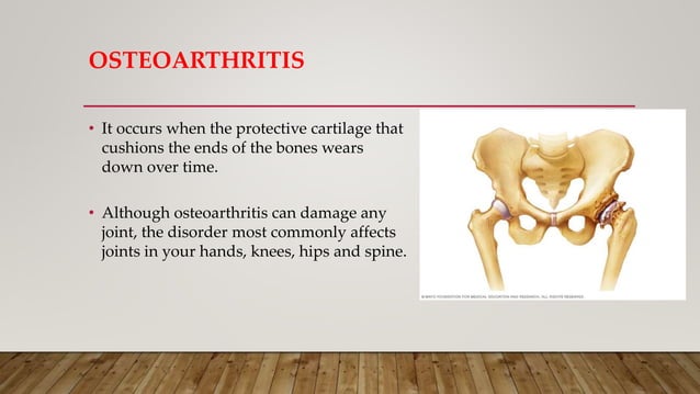 Common Bone Pathologies esp arthrit.pptx | Bone and Joint Conditions ...