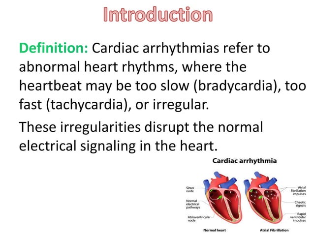 common cardiac arrhythmias.ppsx | Heart and Cardiovascular Diseases | Diseases and Conditions