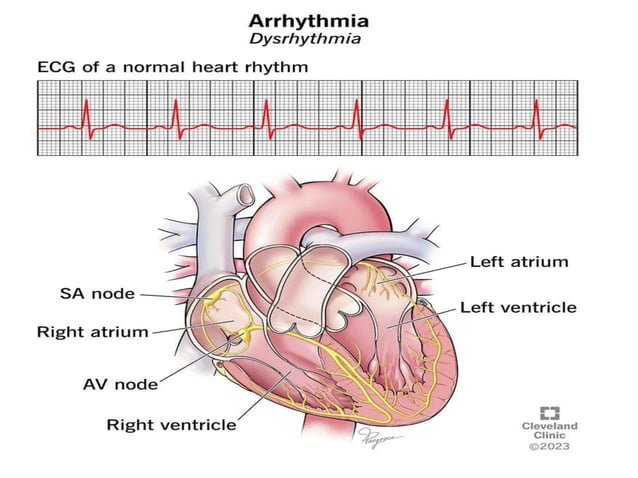 common cardiac arrhythmias.ppsx | Heart and Cardiovascular Diseases | Diseases and Conditions