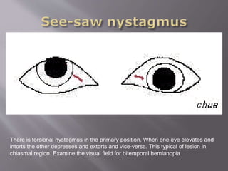 Common Cases: Nystagmus | PPTX