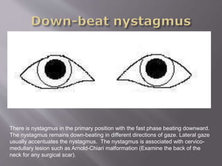 Common Cases: Nystagmus | PPT