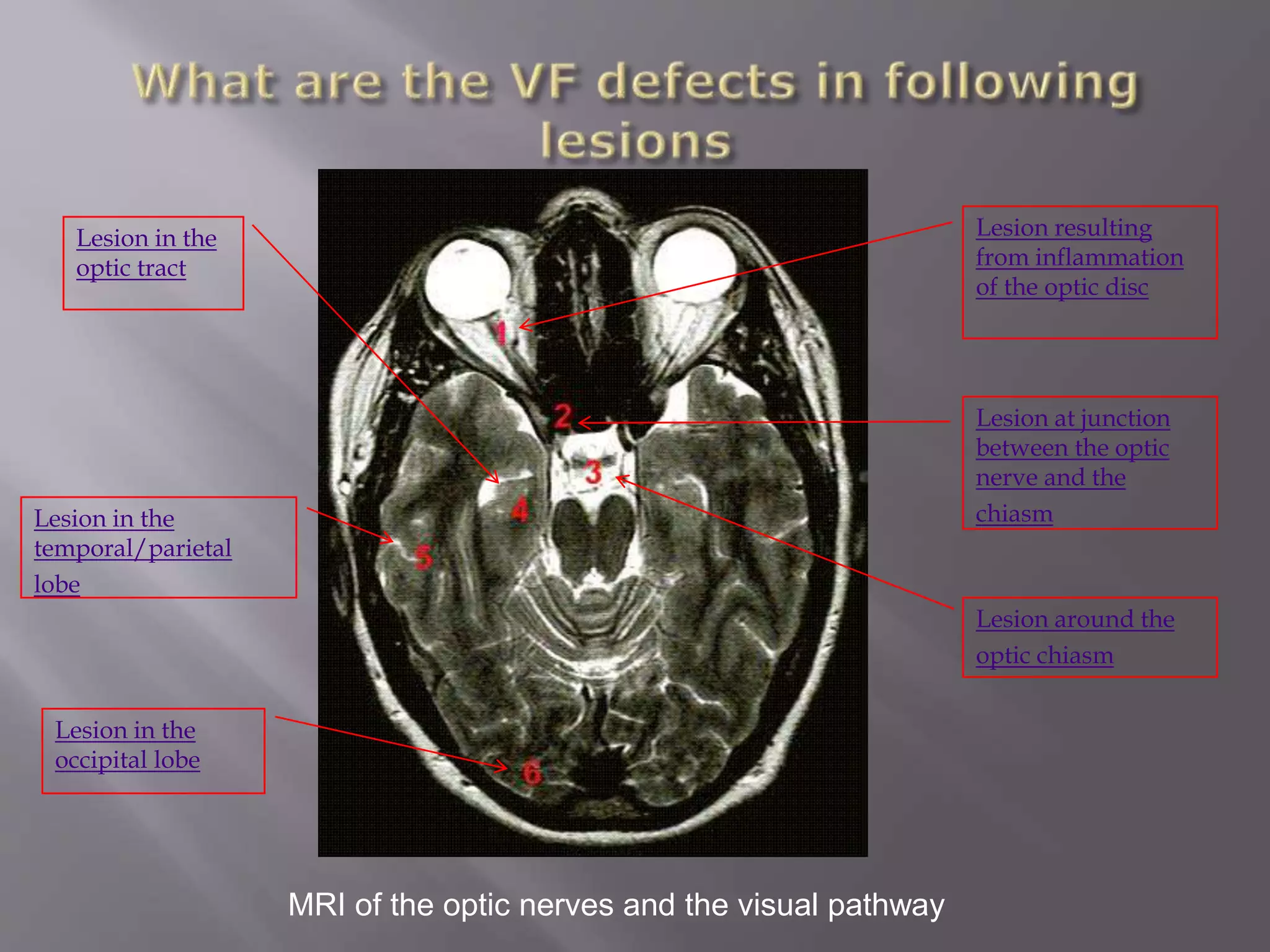 Common Cases: Neurological Visual Field defects | PPTX