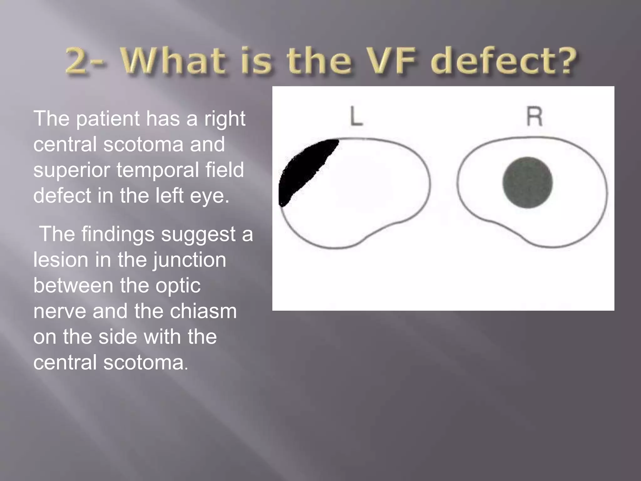 Common Cases Neurological Visual Field Defects Ppt Free Download