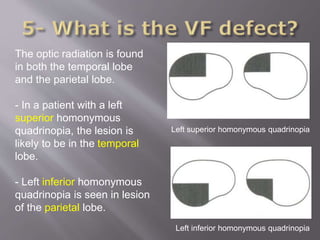 Common Cases: Neurological Visual Field defects | PPTX
