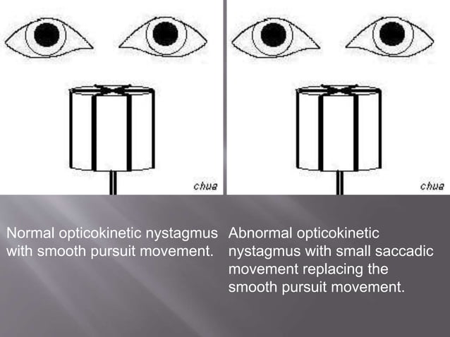 Common Cases: Neurological Visual Field defects | PPTX