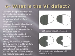 Common Cases: Neurological Visual Field defects | PPTX