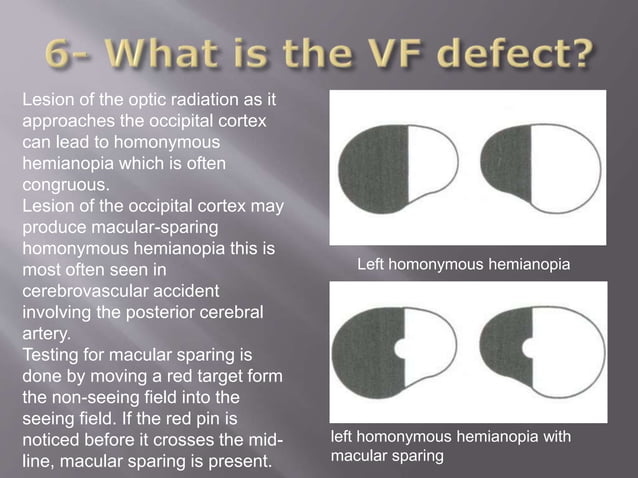 Common Cases: Neurological Visual Field defects | PPTX