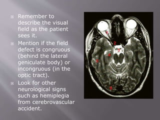 Common Cases: Neurological Visual Field defects | PPTX