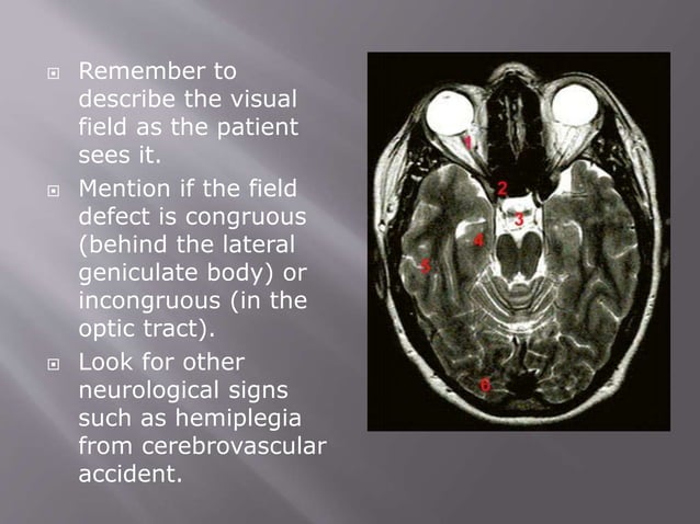 Common Cases: Neurological Visual Field defects | PPTX