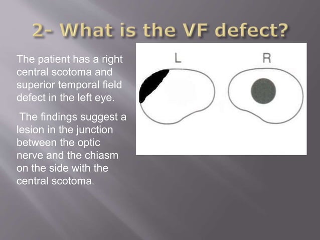 Common Cases: Neurological Visual Field defects | PPTX