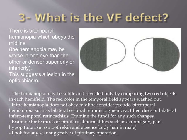 Common Cases: Neurological Visual Field defects | PPTX