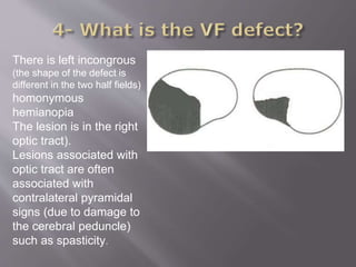 Common Cases: Neurological Visual Field defects | PPTX