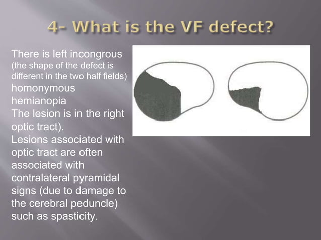 Common Cases: Neurological Visual Field defects | PPTX