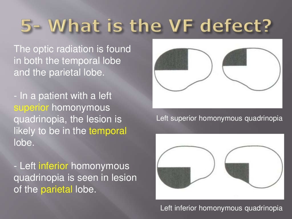 Common Cases Neurological Visual Field Defects